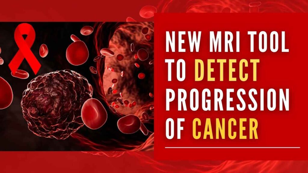 New MRI tool can accurately detect and track the progression of cancer ...